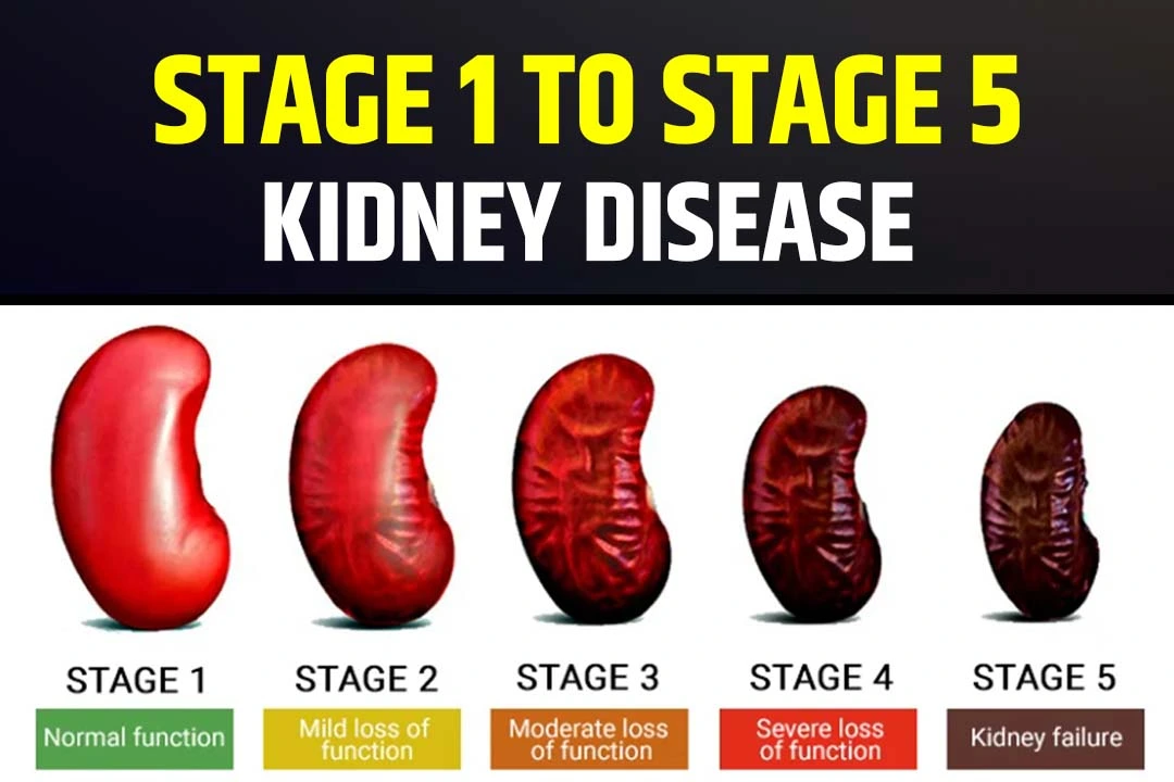 Kidney Disease Stages 1 to 5: Symptoms, Diet & Treatment